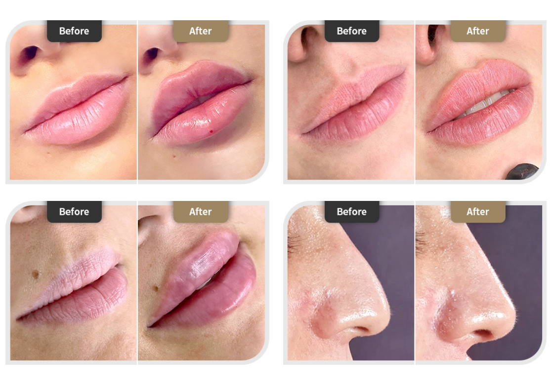 Elaxfill Classic (Deep) 1ml | Sua Pele